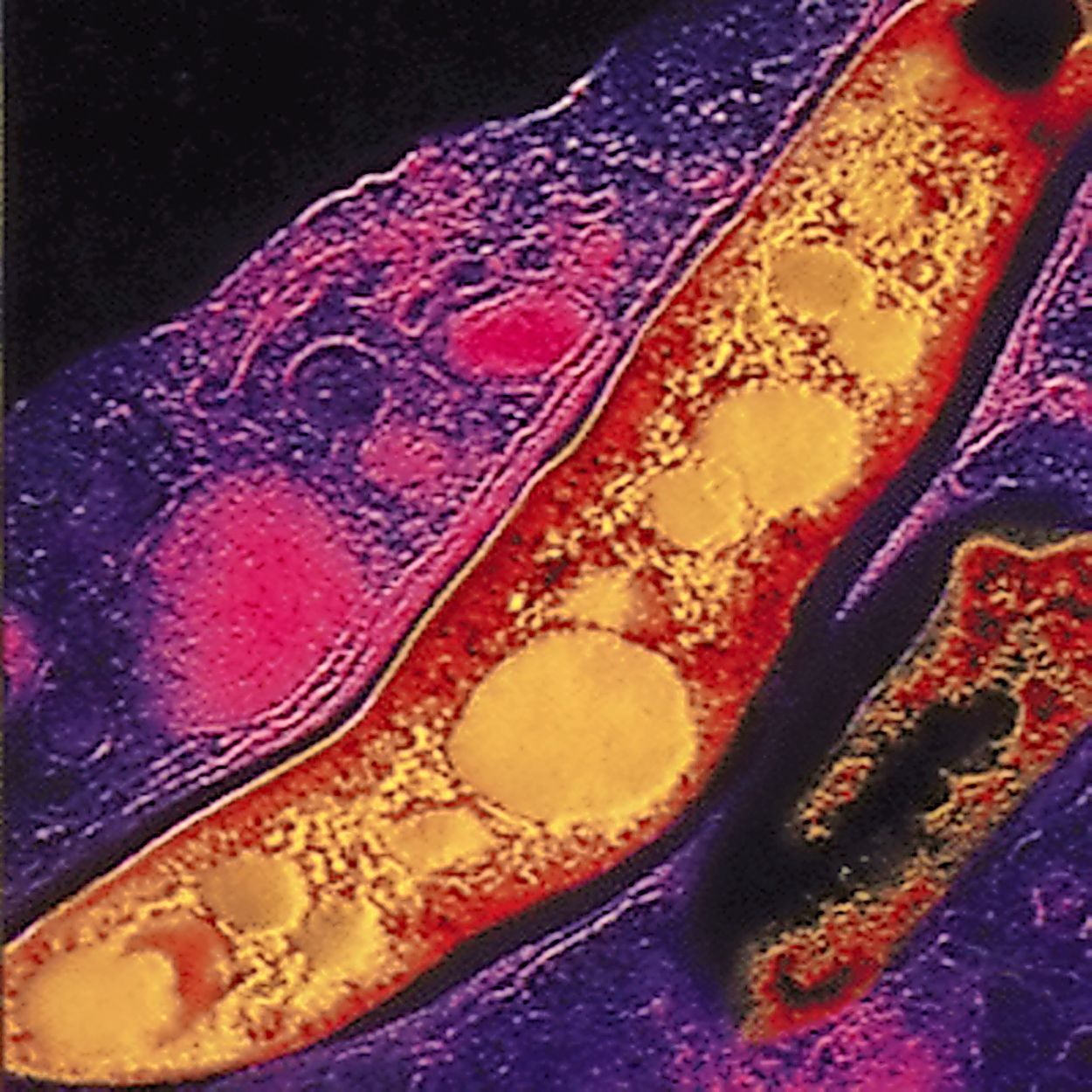 V Štarancanu primer tuberkuloze - Primorske novice